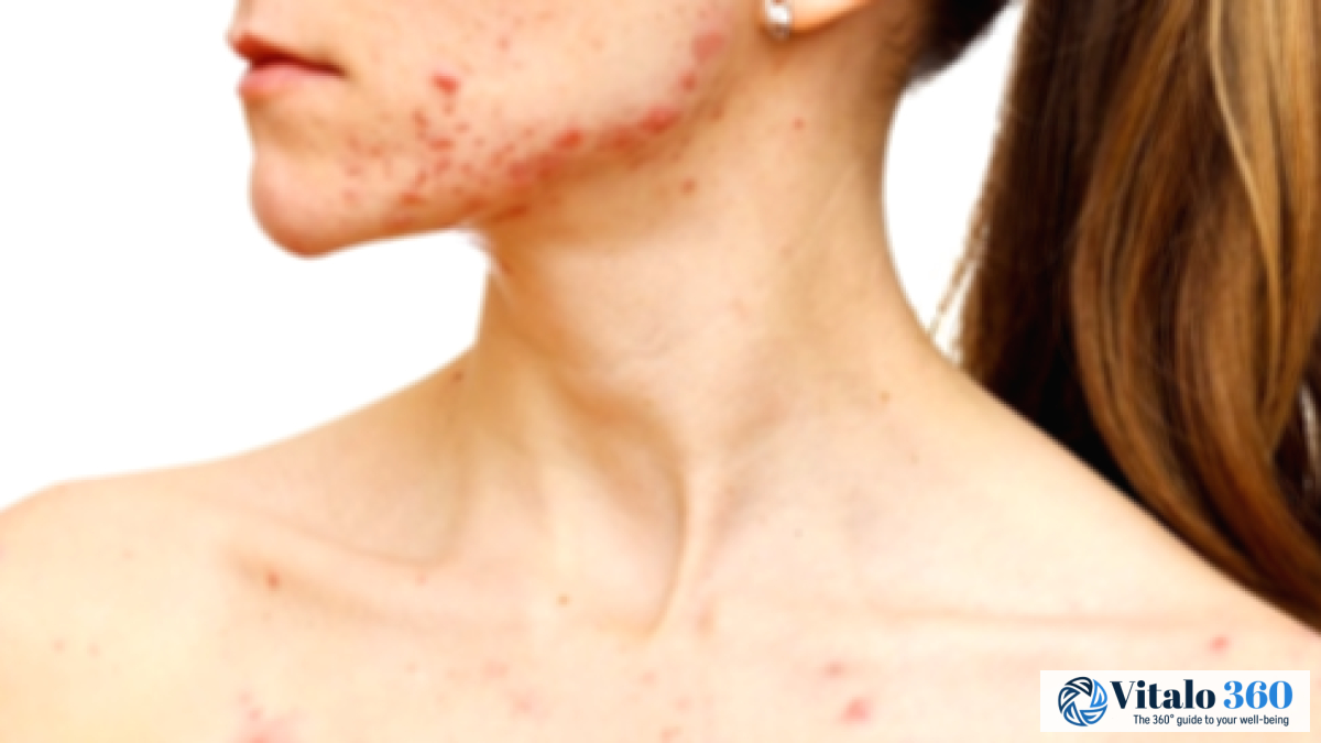 Chest Acne: Causes and Effective Treatment Options